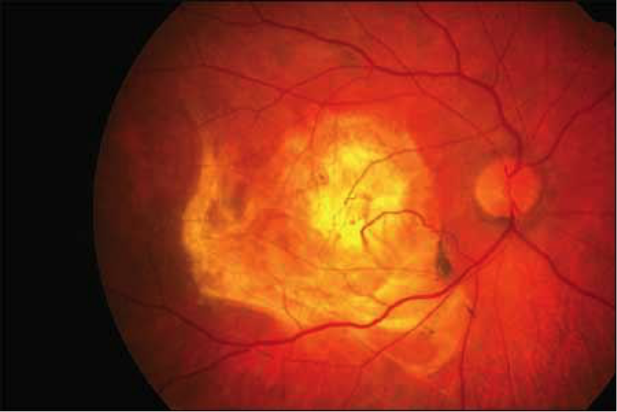 Fovista New Treatment For Wet AMD London