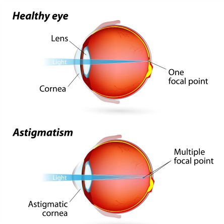 What is Astigmatism? - Jaheed Khan | London Cataract Surgeon